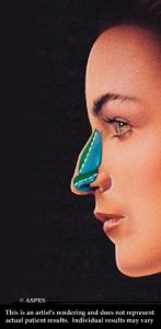 Nose Surgery - Rhinoplasty | Huntsville, AL | Robert J. Knowling MD, FACS