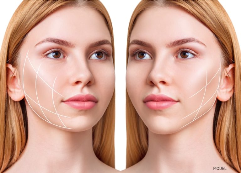 What Is SMAS? Understanding Your Facelift | Robert J. Knowling MD, FACS